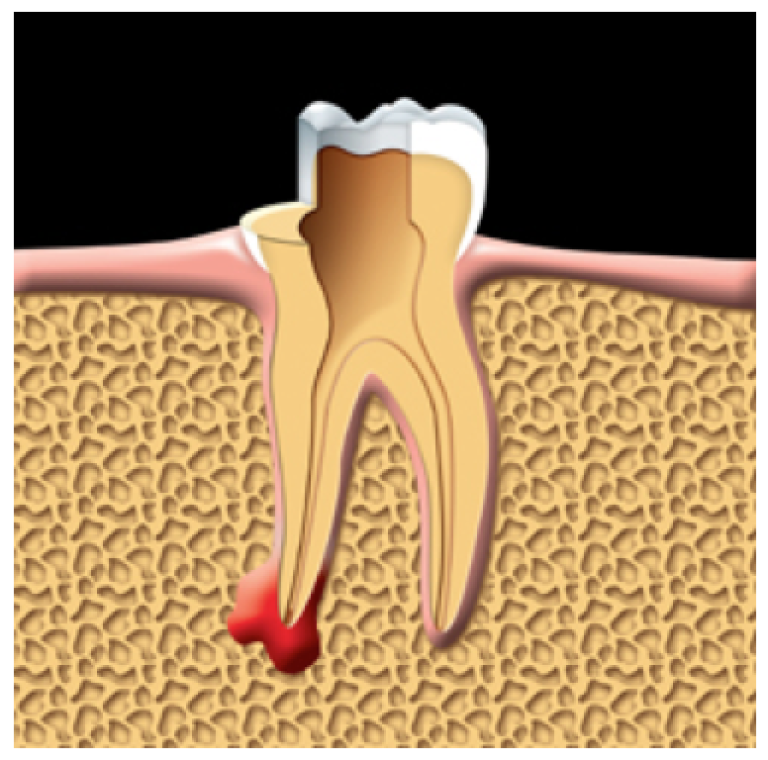 The-damaged-pulp-removed. - Chicopee Park Dental